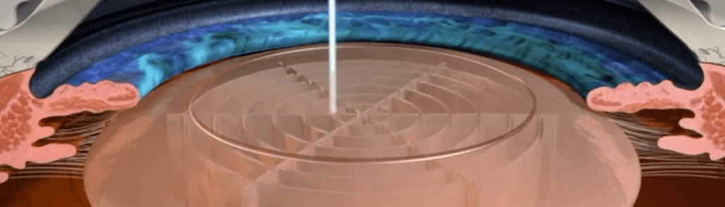 Laser Cataract Technology - Texas Eye Surgeons