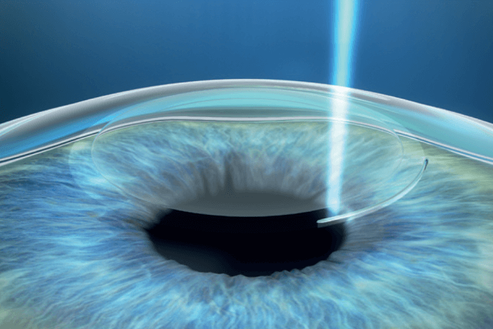 SMILE Eye Surgery Plano | SMILE Eye Surgery Frisco | Texas Eye