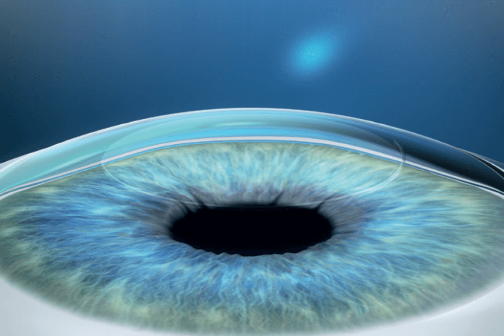 SMILE Eye Surgery Plano | SMILE Eye Surgery Frisco | Texas Eye